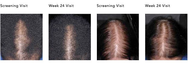 Everything You Need to Know About Rogaine for Women - The Glow Memo